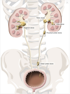 Renal Stones - Core Medical Solutions